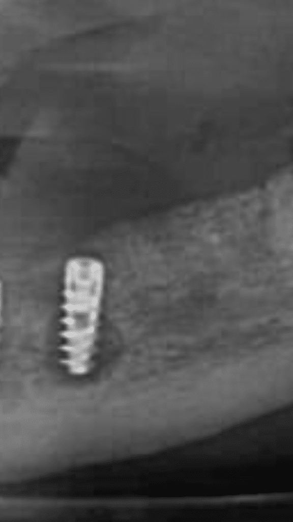 Dental Implant Failure: Reasons & Prevention | Dantkriti Dental Clinic