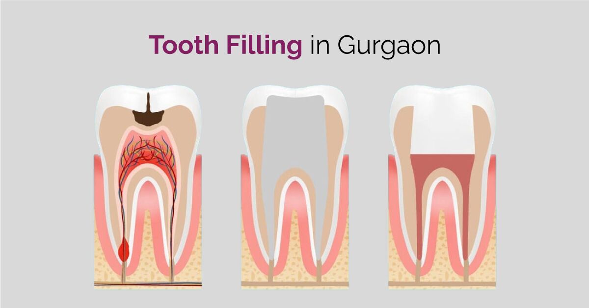 TOOTH FILLINGS IN GURGAON: TREATMENT, TYPES, PROCESS & COST | Dantkriti ...