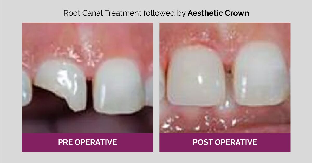 TOOTH FILLINGS IN GURGAON TREATMENT TYPES PROCESS COST Dantkriti Dental Clinic
