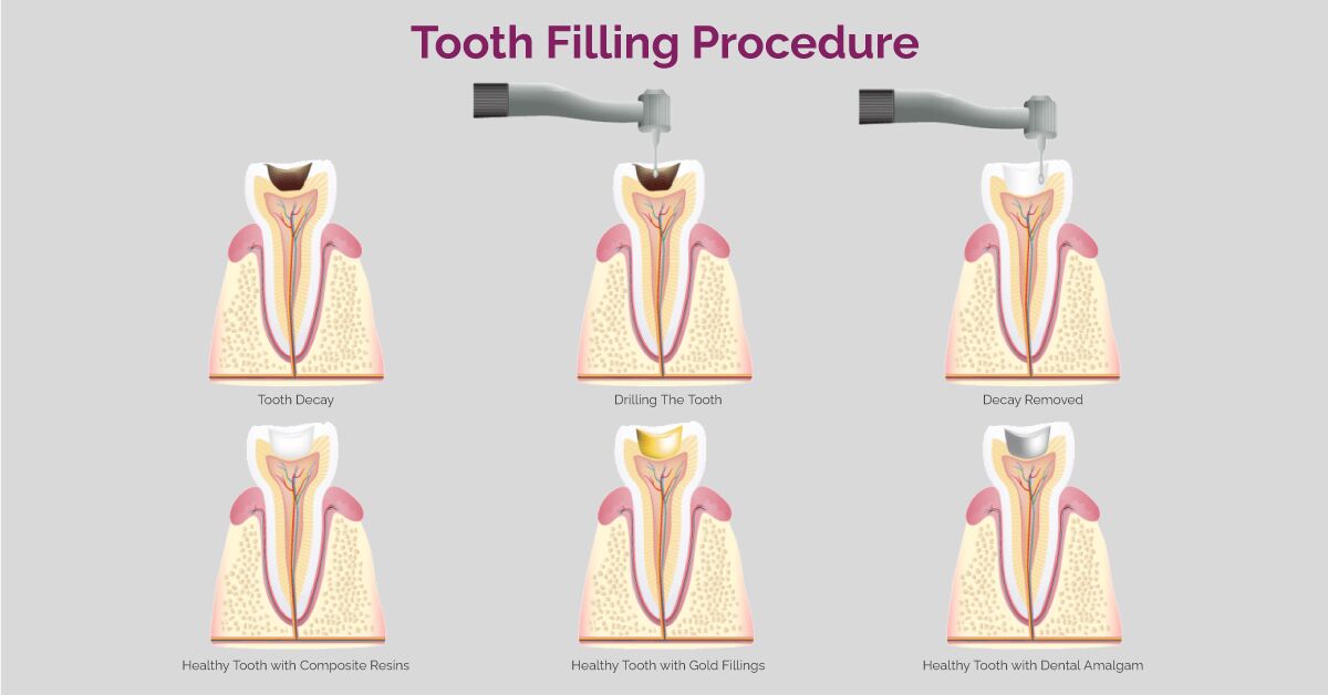 TOOTH FILLINGS IN GURGAON: TREATMENT, TYPES, PROCESS & COST | Dantkriti ...
