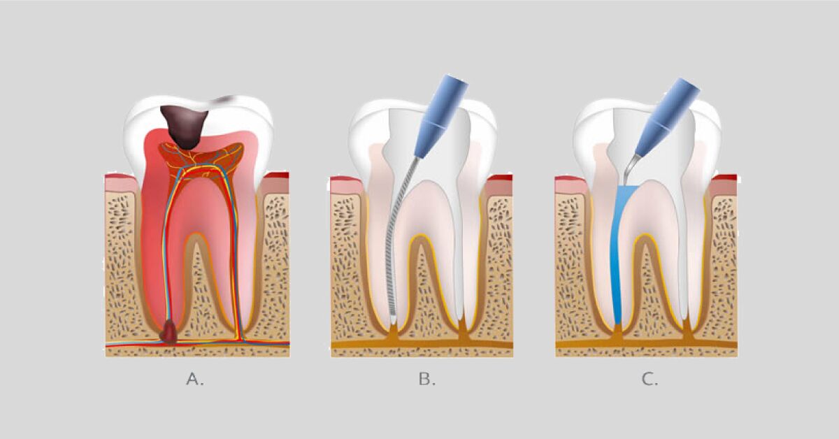 Root Canal Nerve Root Canal Treatment | Jeffersonville, IN