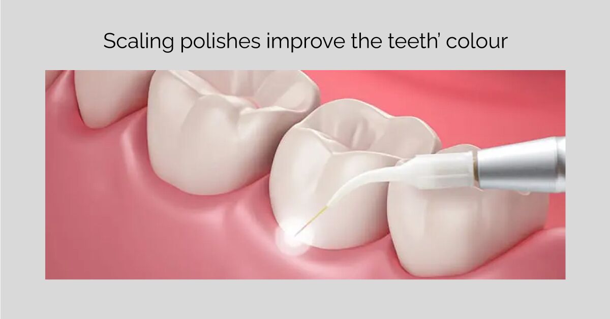 Scaling Damage Your Teeth Enamel | Dental Implant Clinic