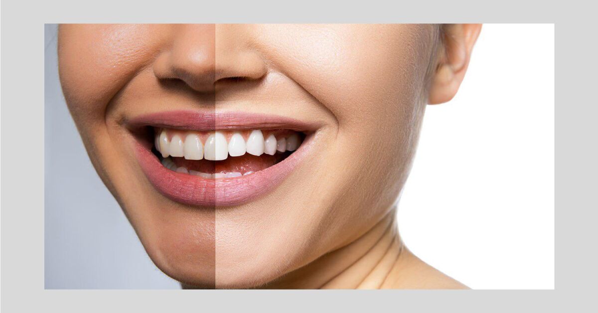 Scaling Damage Your Teeth Enamel | Dental Implant Clinic