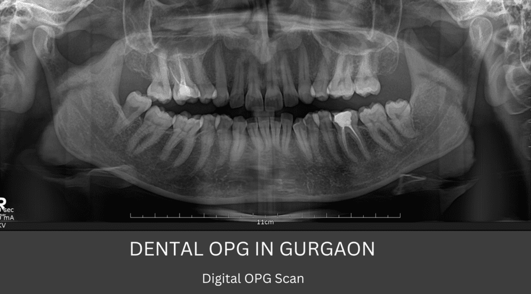 Dental OPG X-Ray In Gurgaon- Cost Effective Digital OPG ...